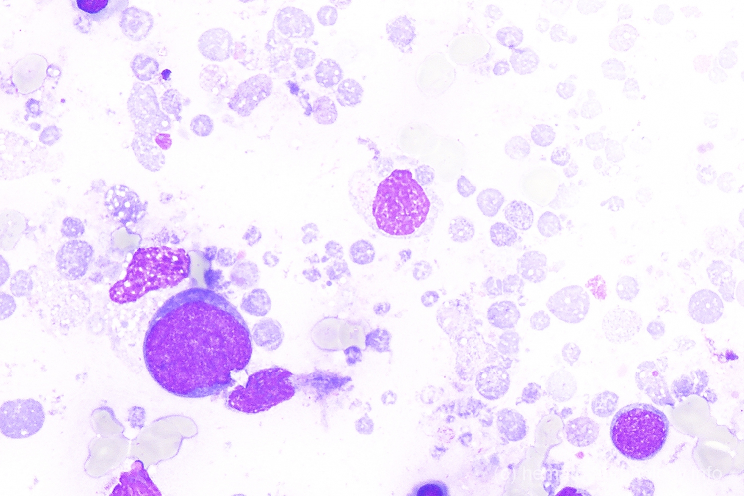 Diffuse Large B-cell Lymphoma (DLBCL) - Hematomorphology, a databank ...