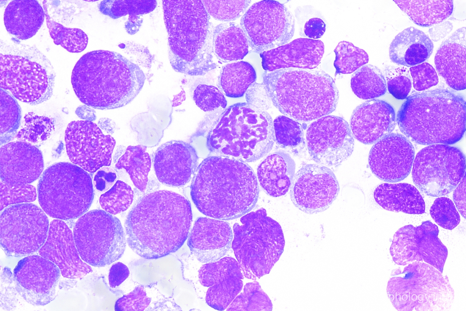 Diffuse Large B-cell Lymphoma (DLBCL) - Hematomorphology, a databank ...