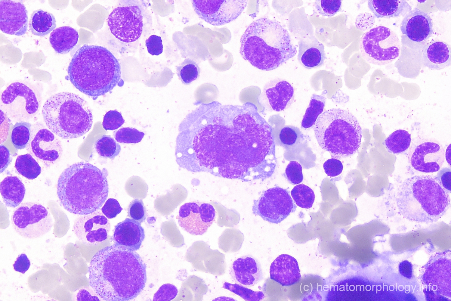 Diffuse Large B-cell Lymphoma (DLBCL) - Hematomorphology, a databank ...