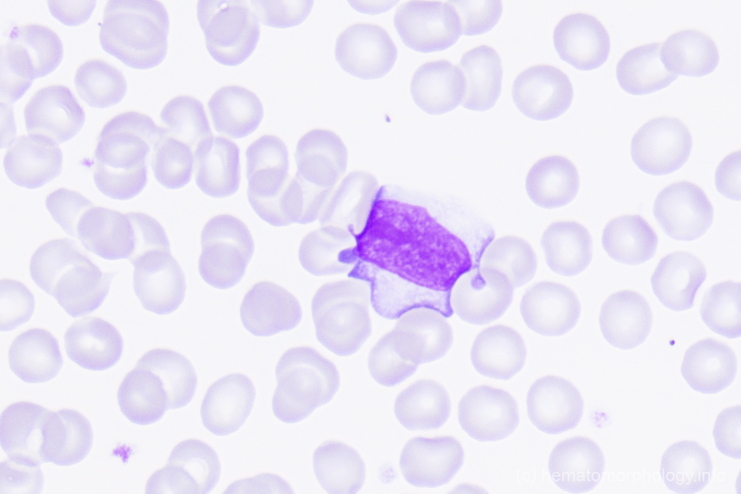 Infectious mononucleosis - Hematomorphology, a databank / imagebank for ...