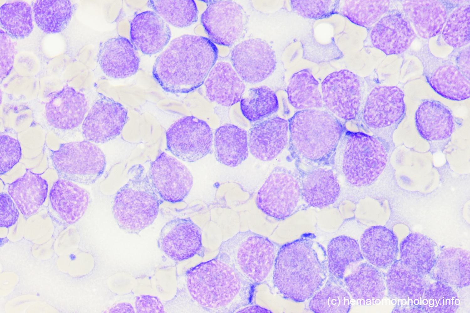 Ewing sarcoma - Hematomorphology, a databank / imagebank for hematology ...