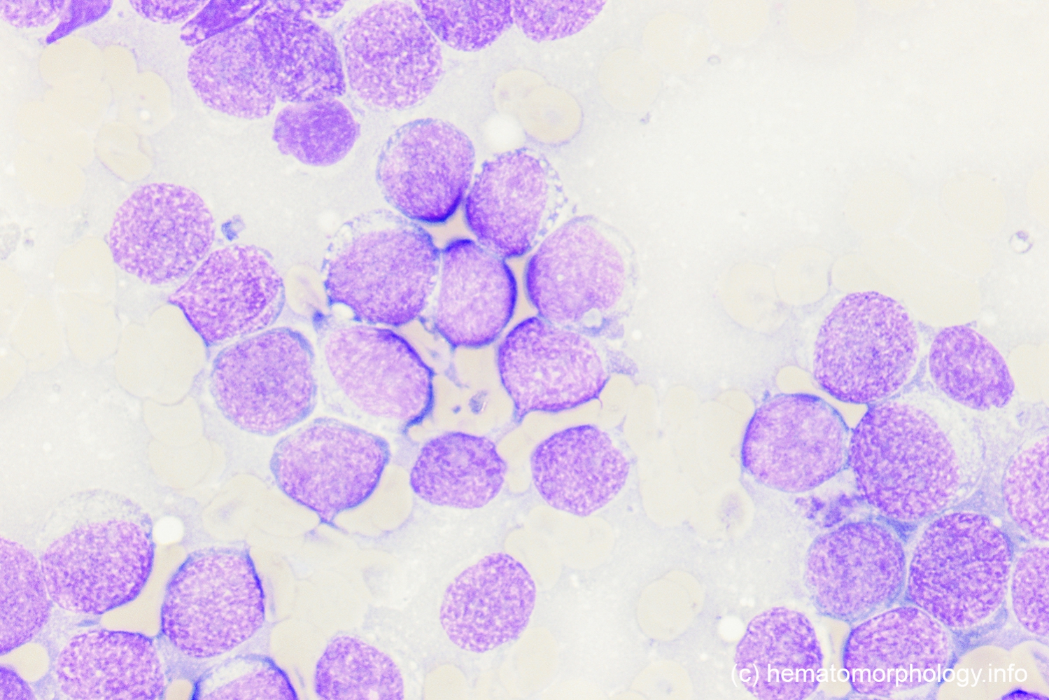 Ewing sarcoma - Hematomorphology, a databank / imagebank for hematology ...