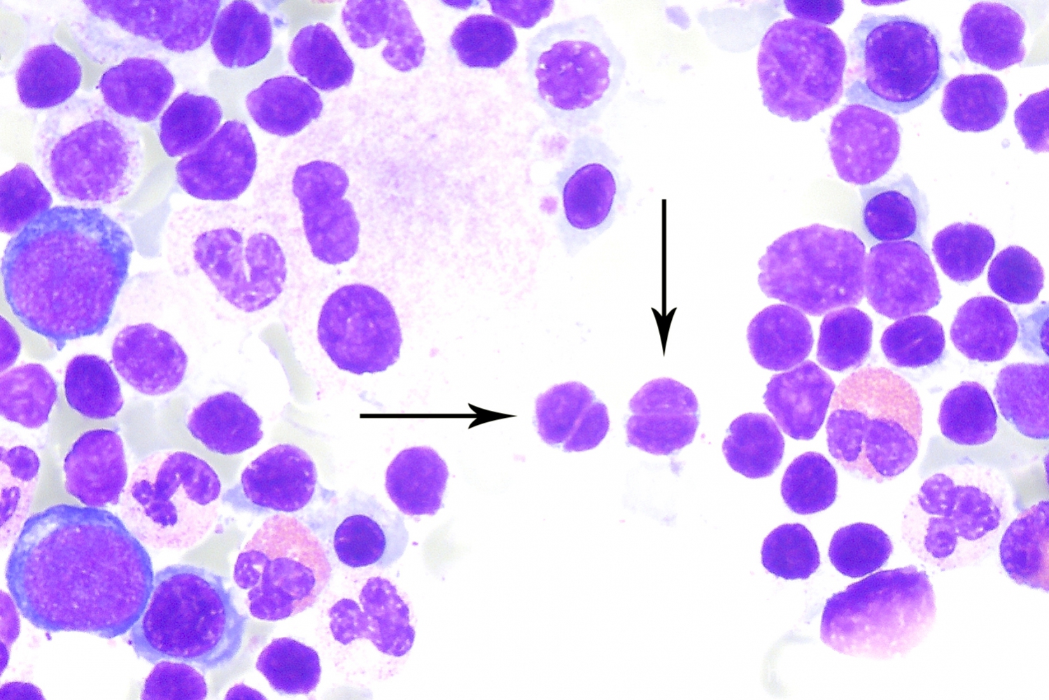 Follicular Lymphoma (FL) - Hematomorphology, a databank / imagebank for ...