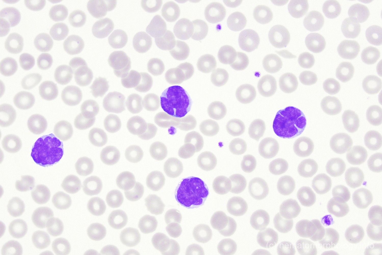 Follicular Lymphoma (FL) - Hematomorphology, a databank / imagebank for ...
