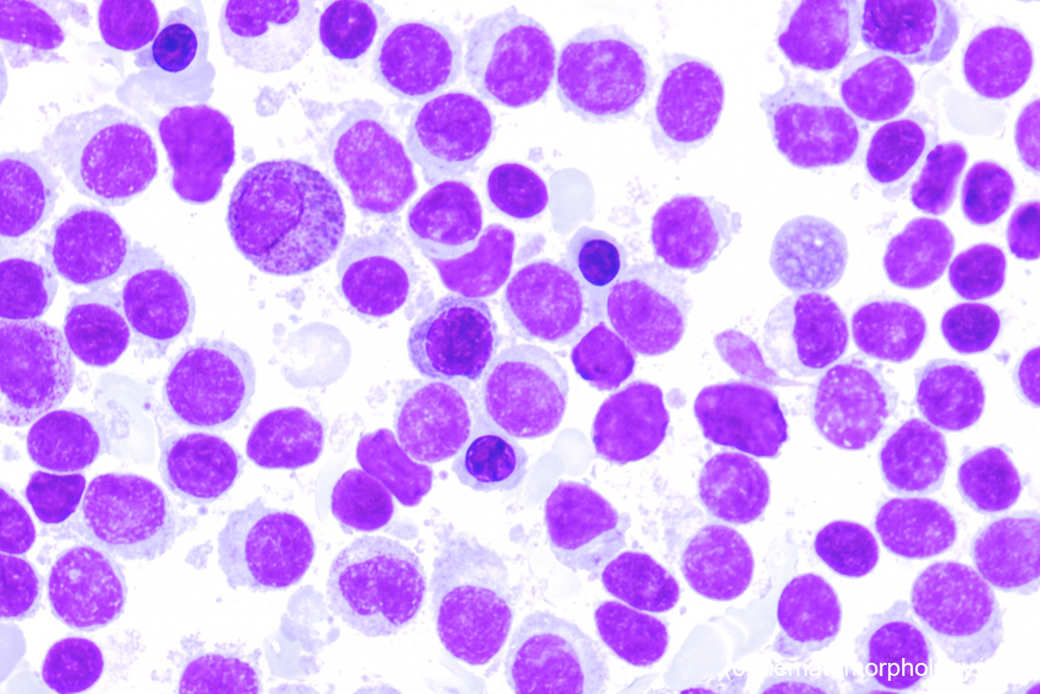 Hairy Cell Leukemia (HCL) - Hematomorphology, a databank / imagebank ...