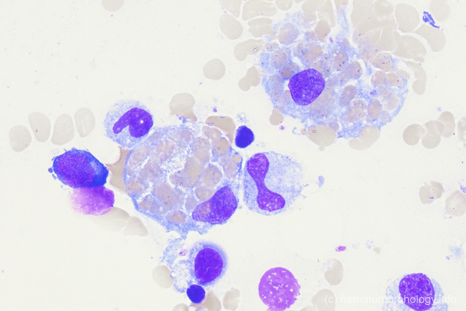 Hemophagocytic Lympho Histiocytosis (HLH) - Hematomorphology, a ...