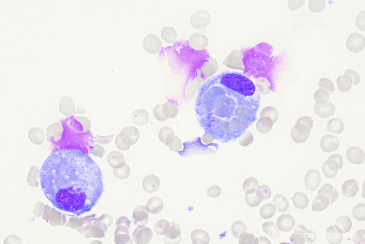 Hemophagocytic Lympho Histiocytosis (HLH) - Hematomorphology, a ...