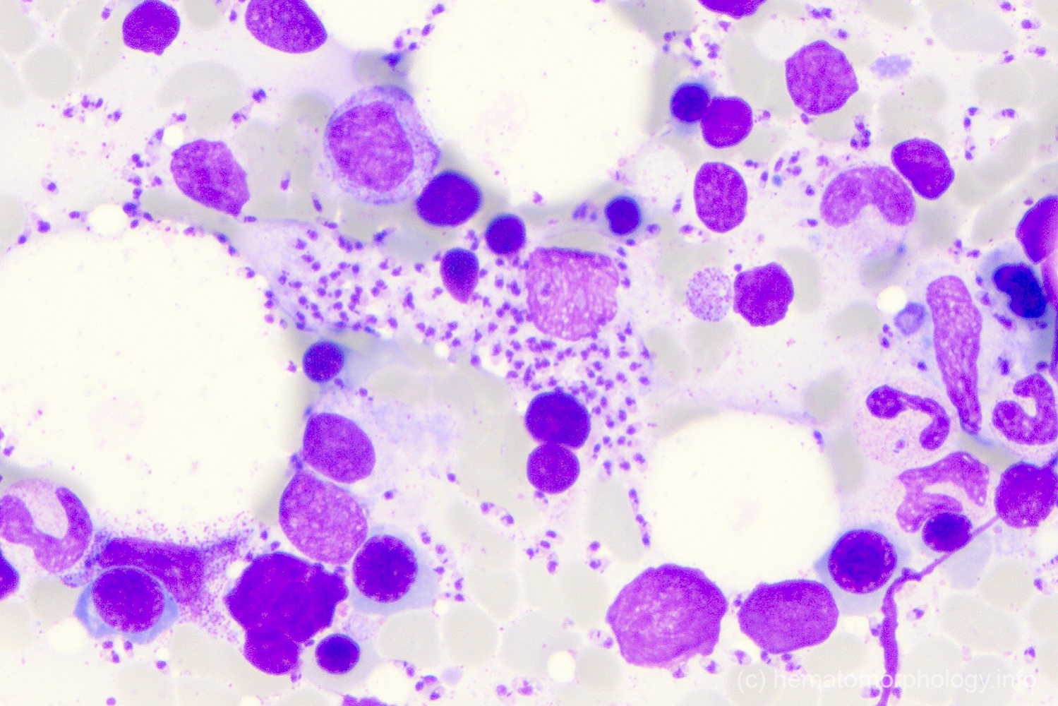 Leishmaniasis - Hematomorphology, a databank / imagebank for hematology ...