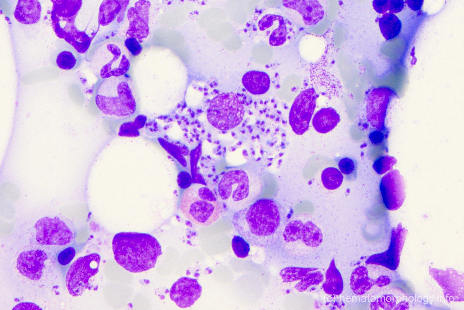 Leishmaniasis - Hematomorphology, a databank / imagebank for hematology ...