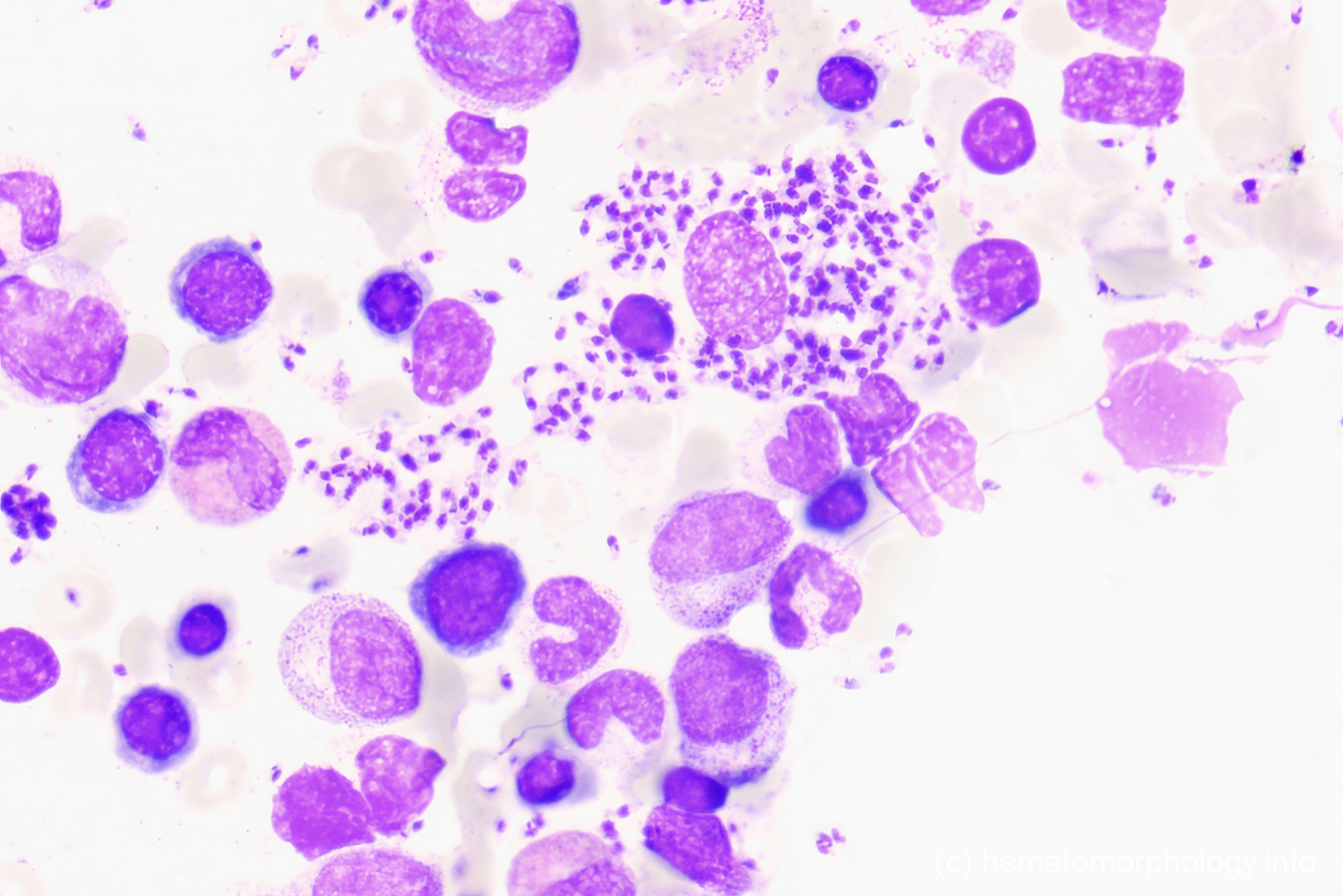 Leishmaniasis - Hematomorphology, a databank / imagebank for hematology ...