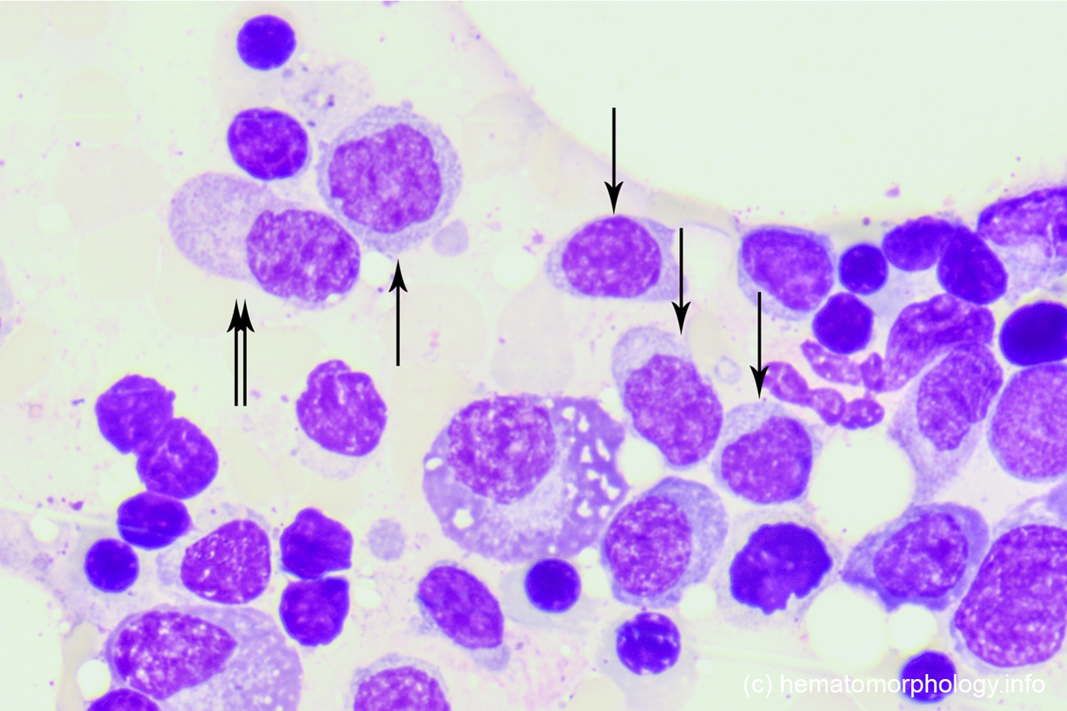 MALT lymphoma - Hematomorphology, a databank / imagebank for hematology ...
