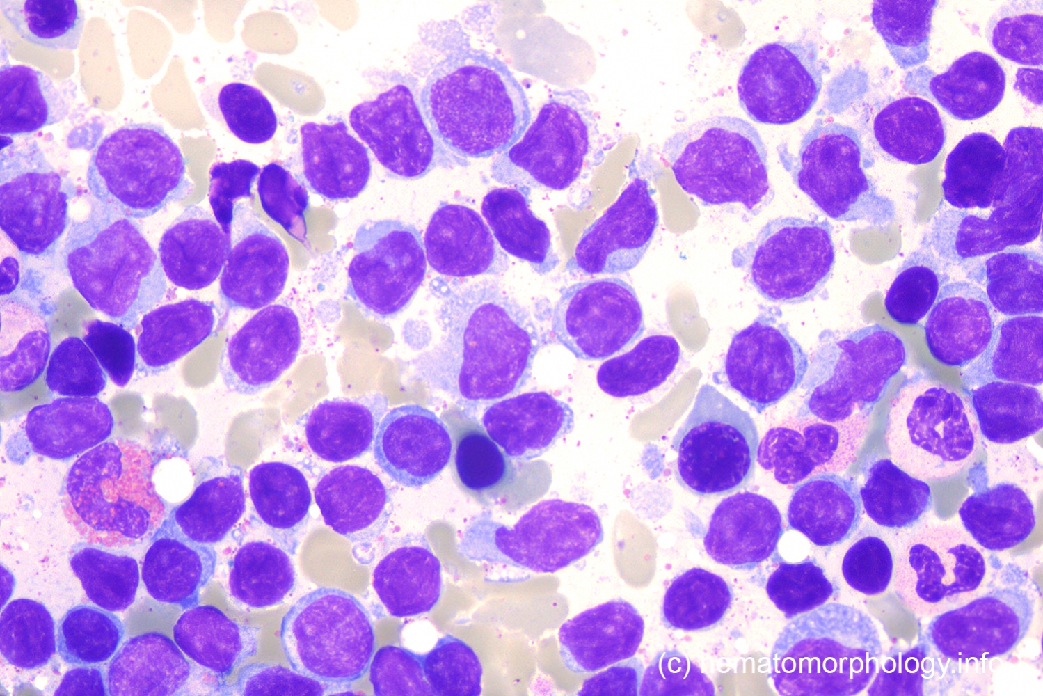 MALT lymphoma - Hematomorphology, a databank / imagebank for hematology ...