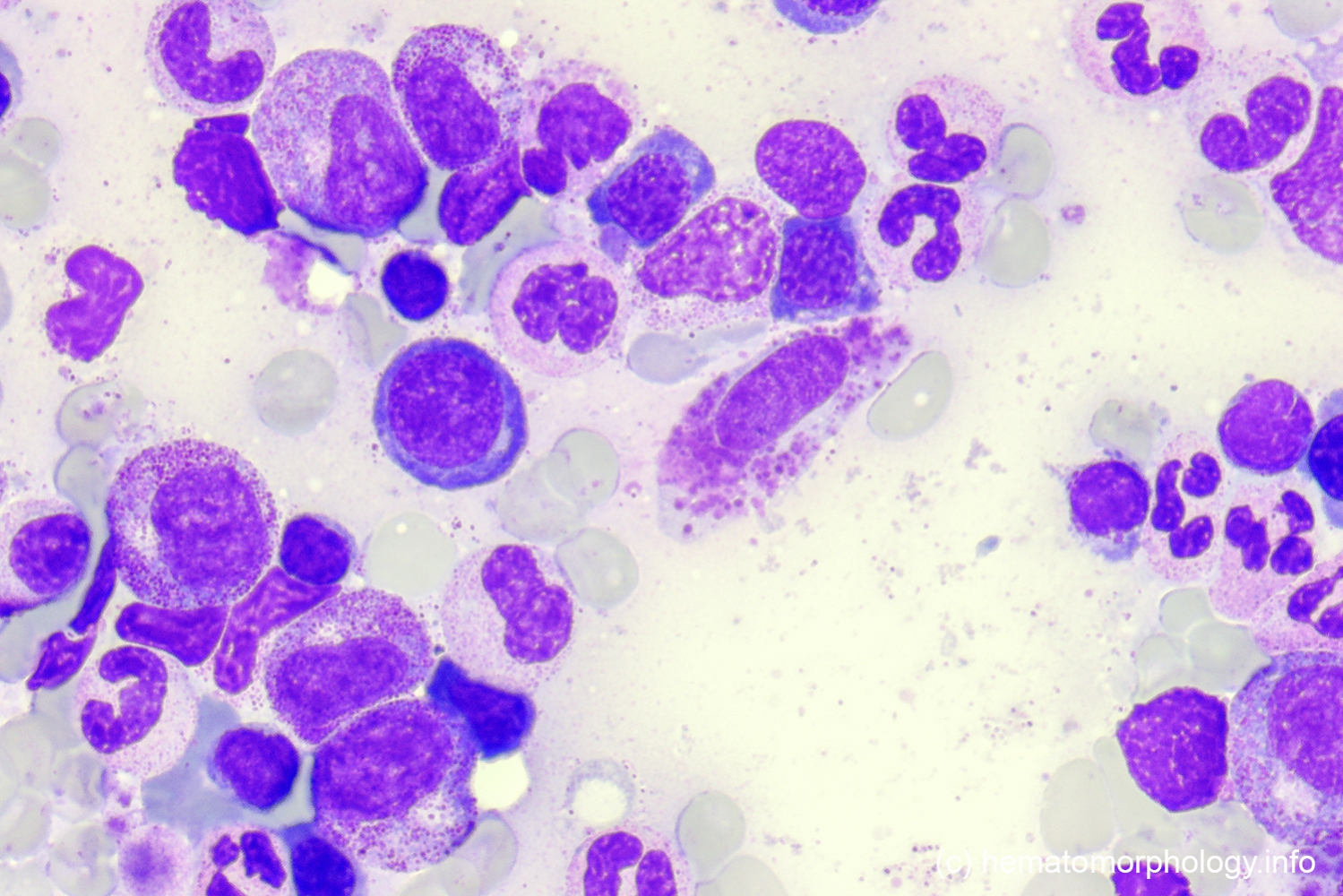 Mastocytosis - Hematomorphology, a databank / imagebank for hematology ...