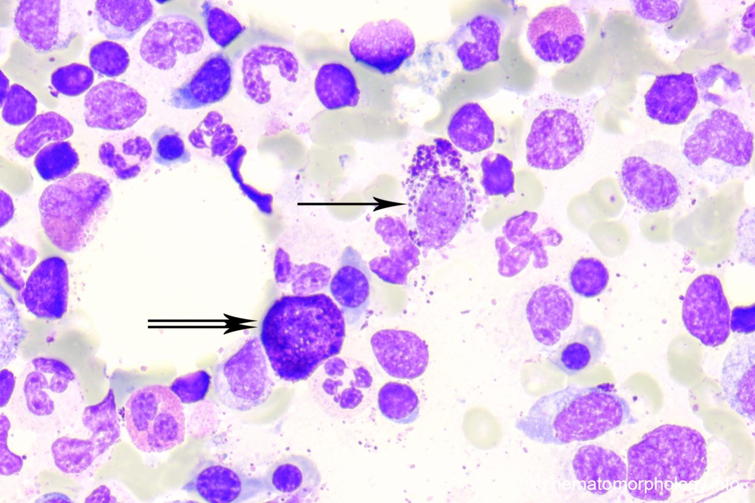 Mastocytosis - Hematomorphology, a databank / imagebank for hematology ...