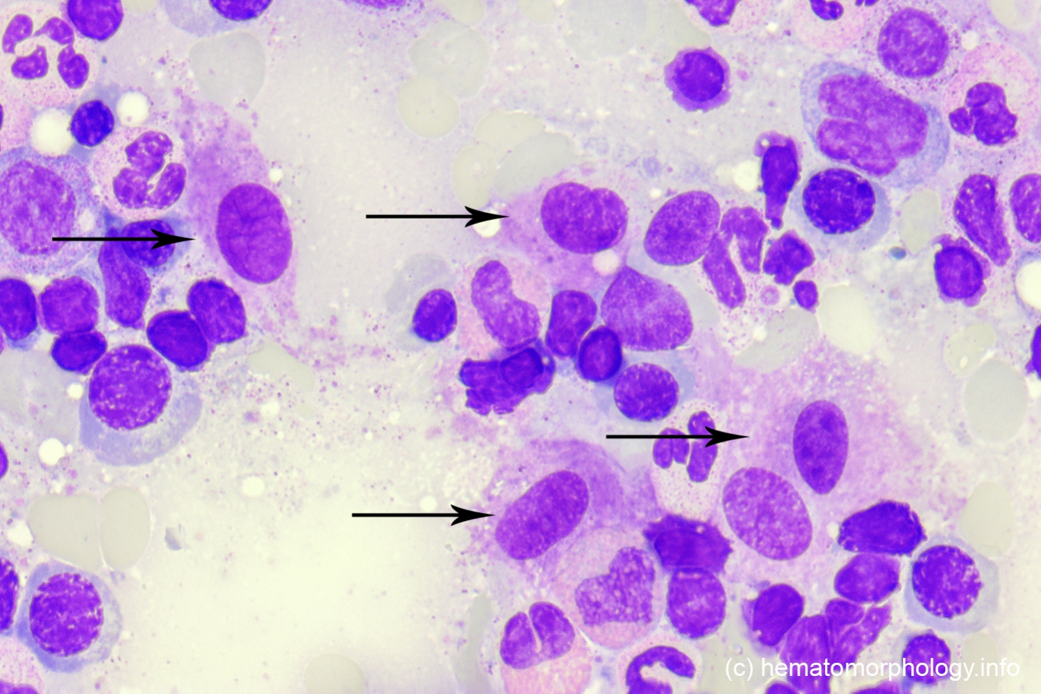 Mastocytosis - Hematomorphology, a databank / imagebank for hematology ...