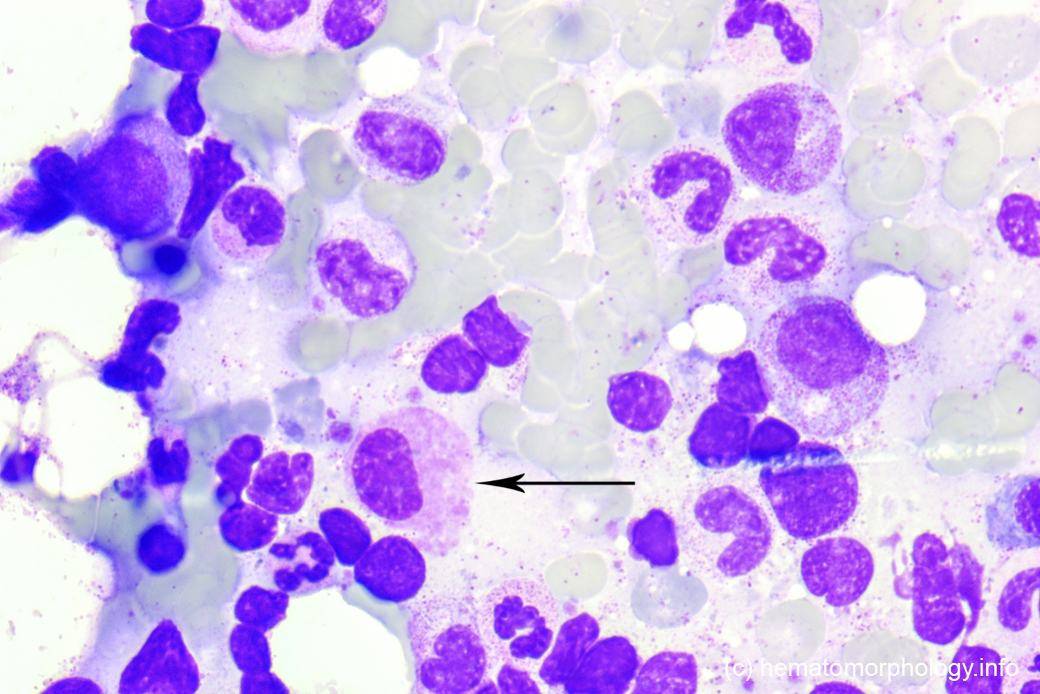 Mastocytosis - Hematomorphology, a databank / imagebank for hematology ...