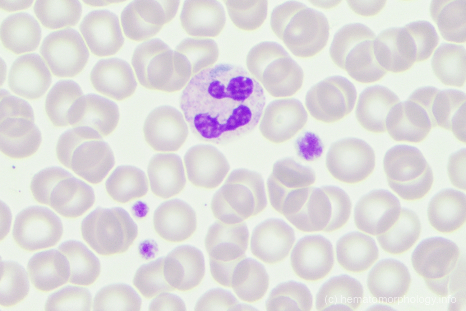 May Hegglin anomaly - Hematomorphology, a databank / imagebank for ...