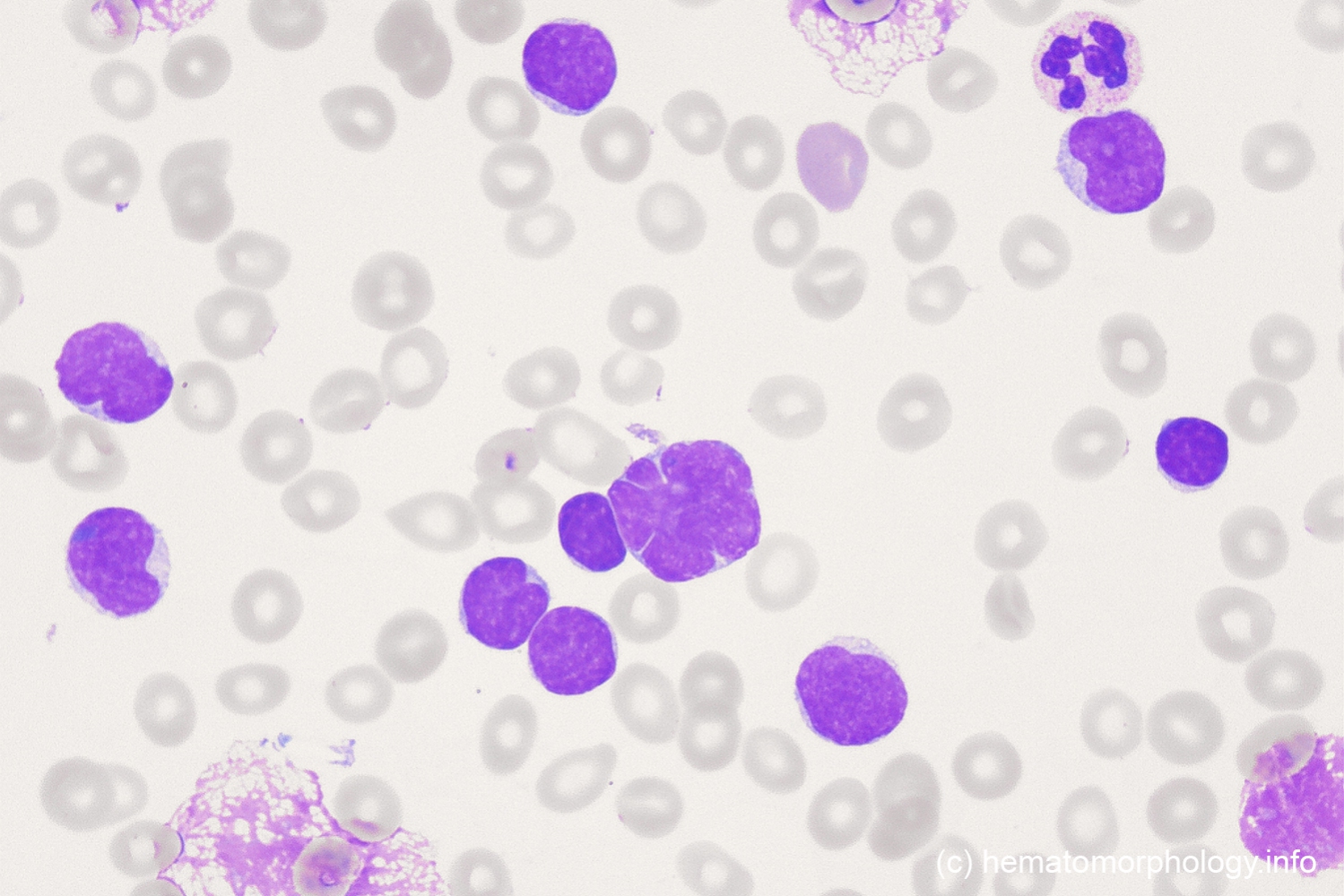 Mantle Cell Lymphoma (MCL) - Hematomorphology, a databank / imagebank ...