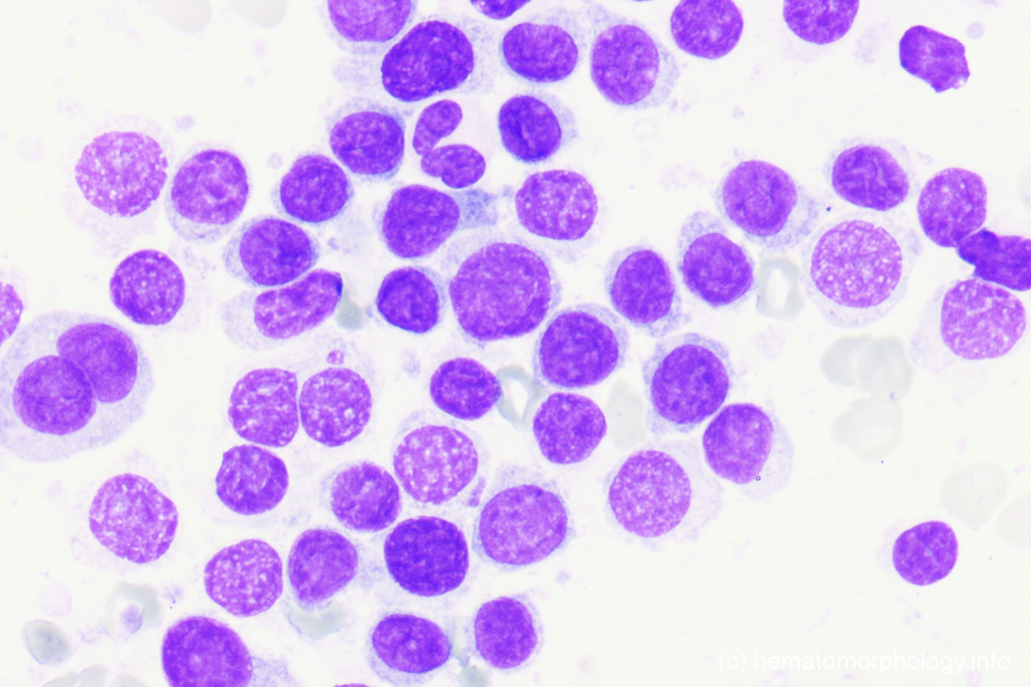 Mantle Cell Lymphoma (MCL) - Hematomorphology, a databank / imagebank ...