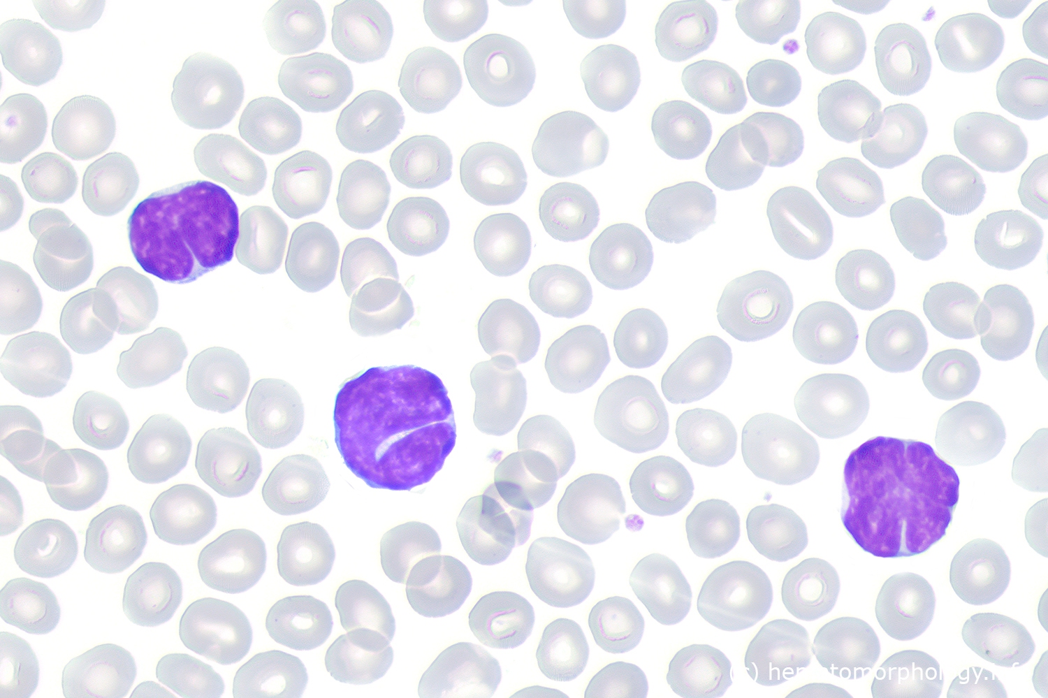 Mantle Cell Lymphoma (MCL) - Hematomorphology, a databank / imagebank ...