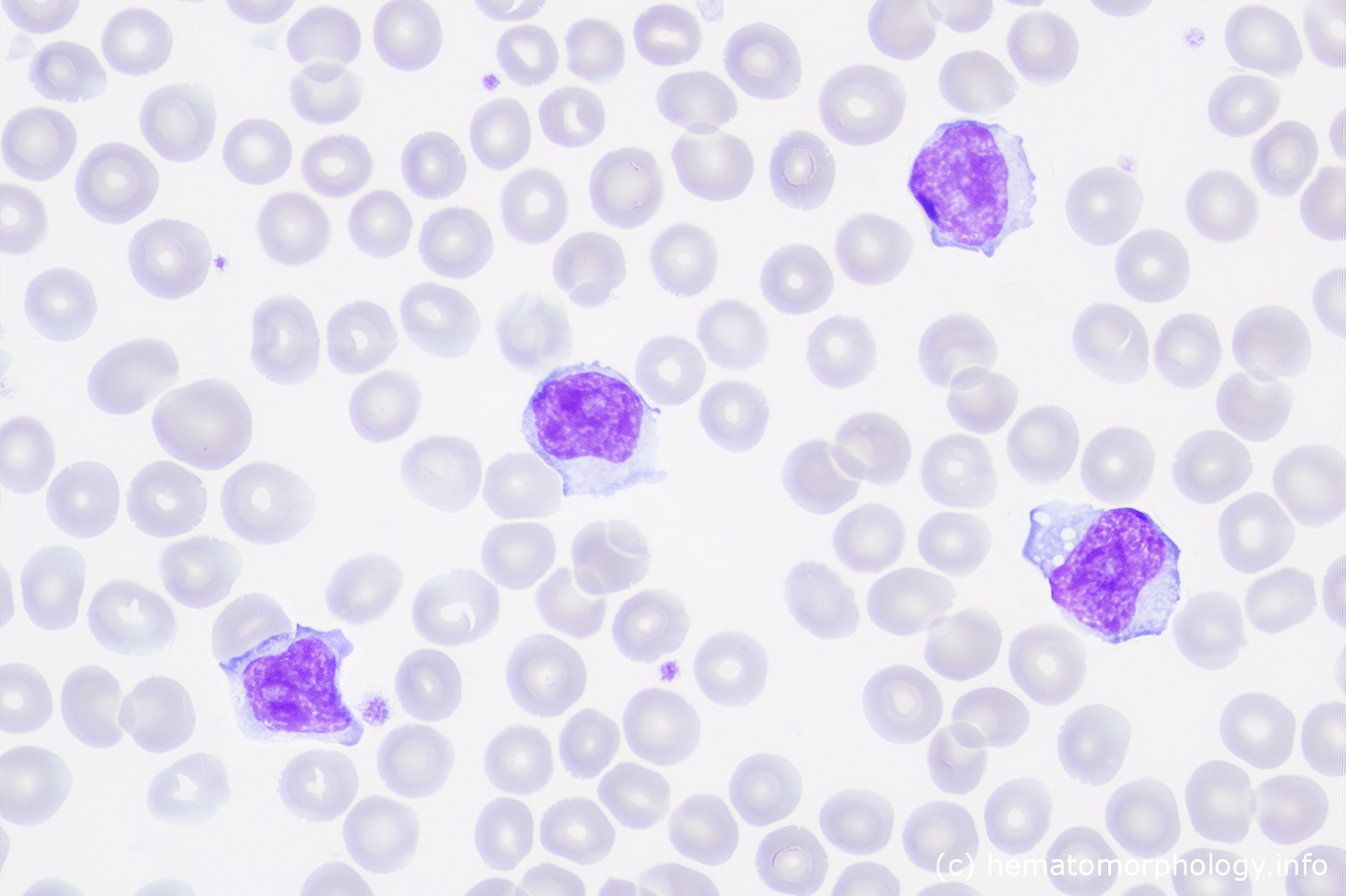 Mantle Cell Lymphoma (MCL) - Hematomorphology, a databank / imagebank ...