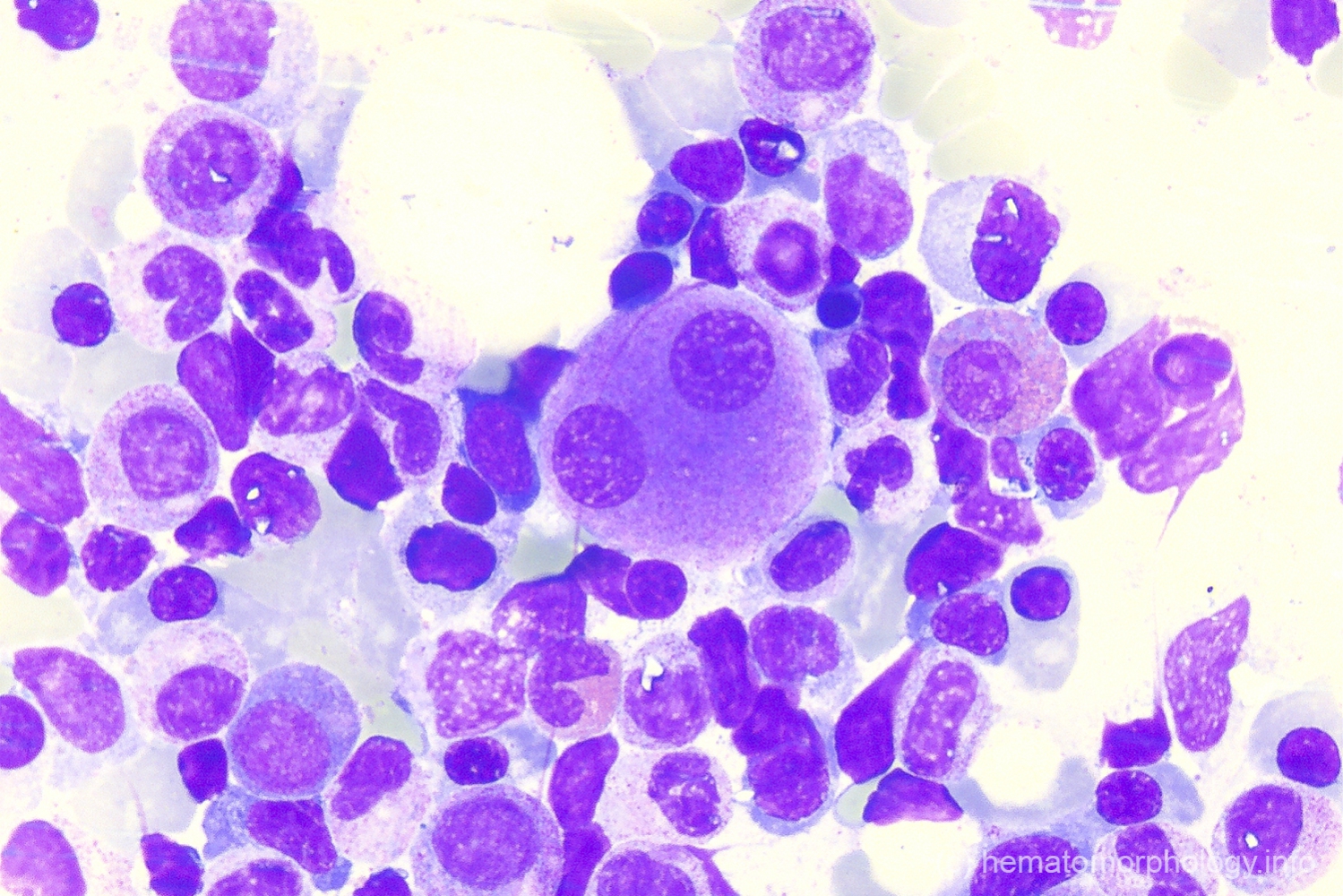 MDS multi lineage dysplasia (MLD) - Hematomorphology, a databank ...