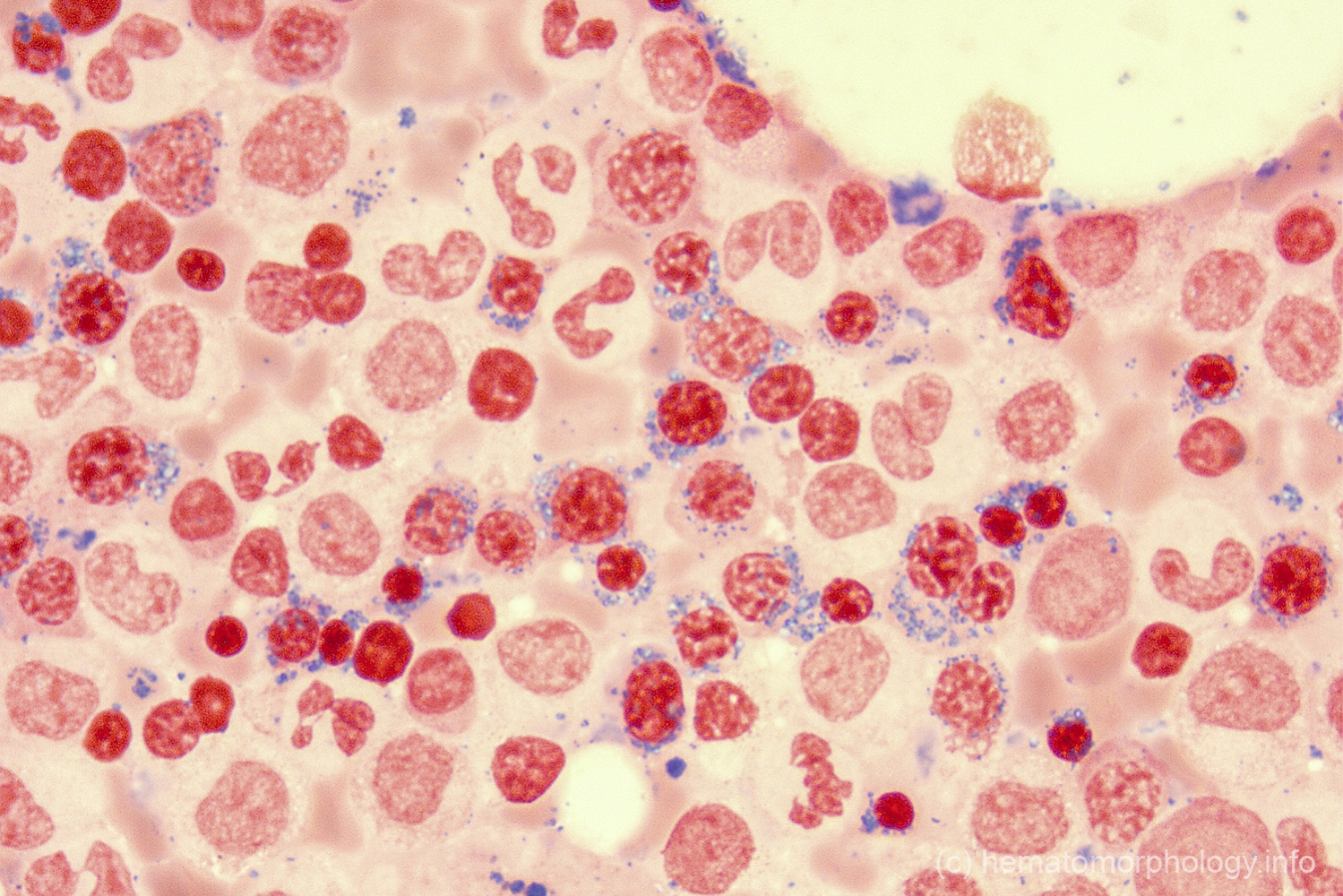 MDS with ring sideroblasts (RS) - Hematomorphology, a databank ...