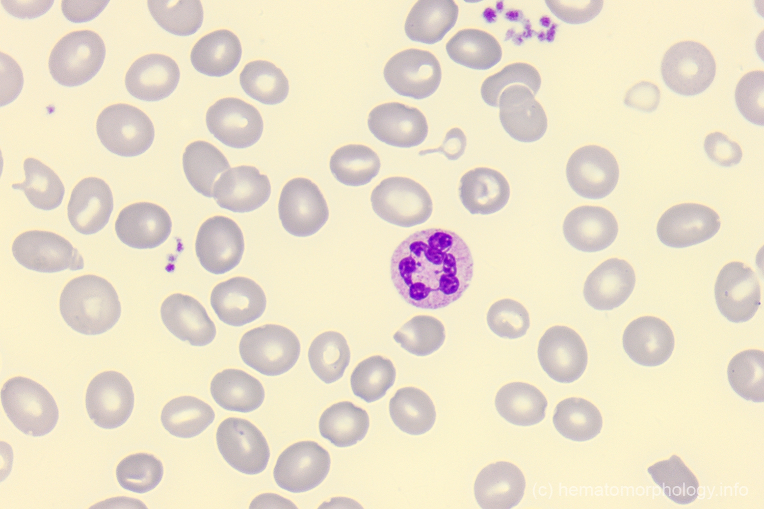 Megaloblastic anemia - Hematomorphology, a databank / imagebank for ...
