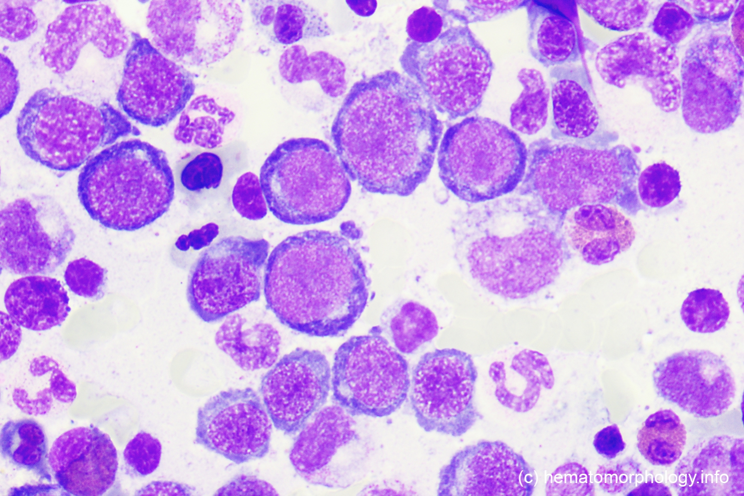 Megaloblastic anemia - Hematomorphology, a databank / imagebank for ...