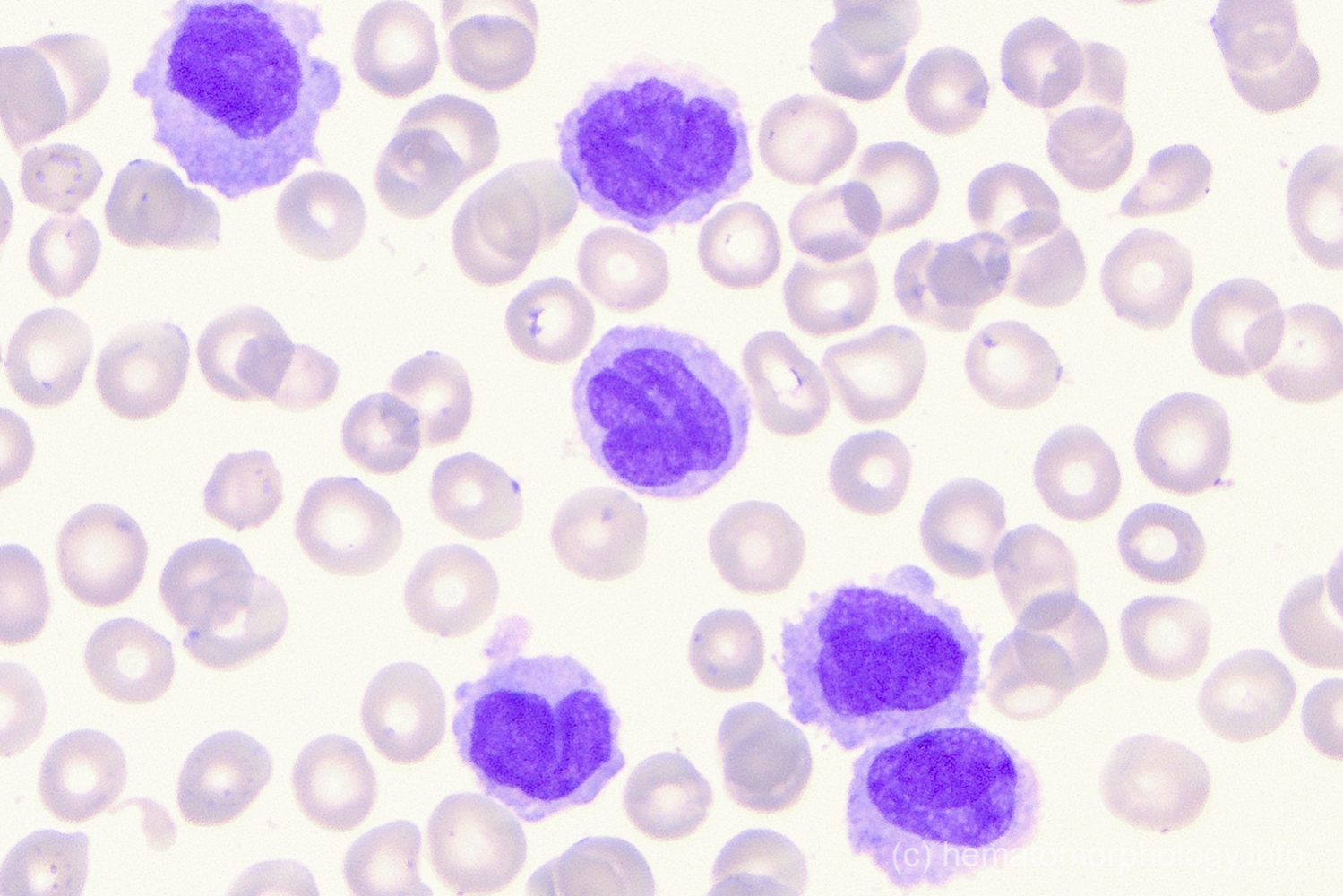 Monocytes - Hematomorphology, a databank / imagebank for hematology ...