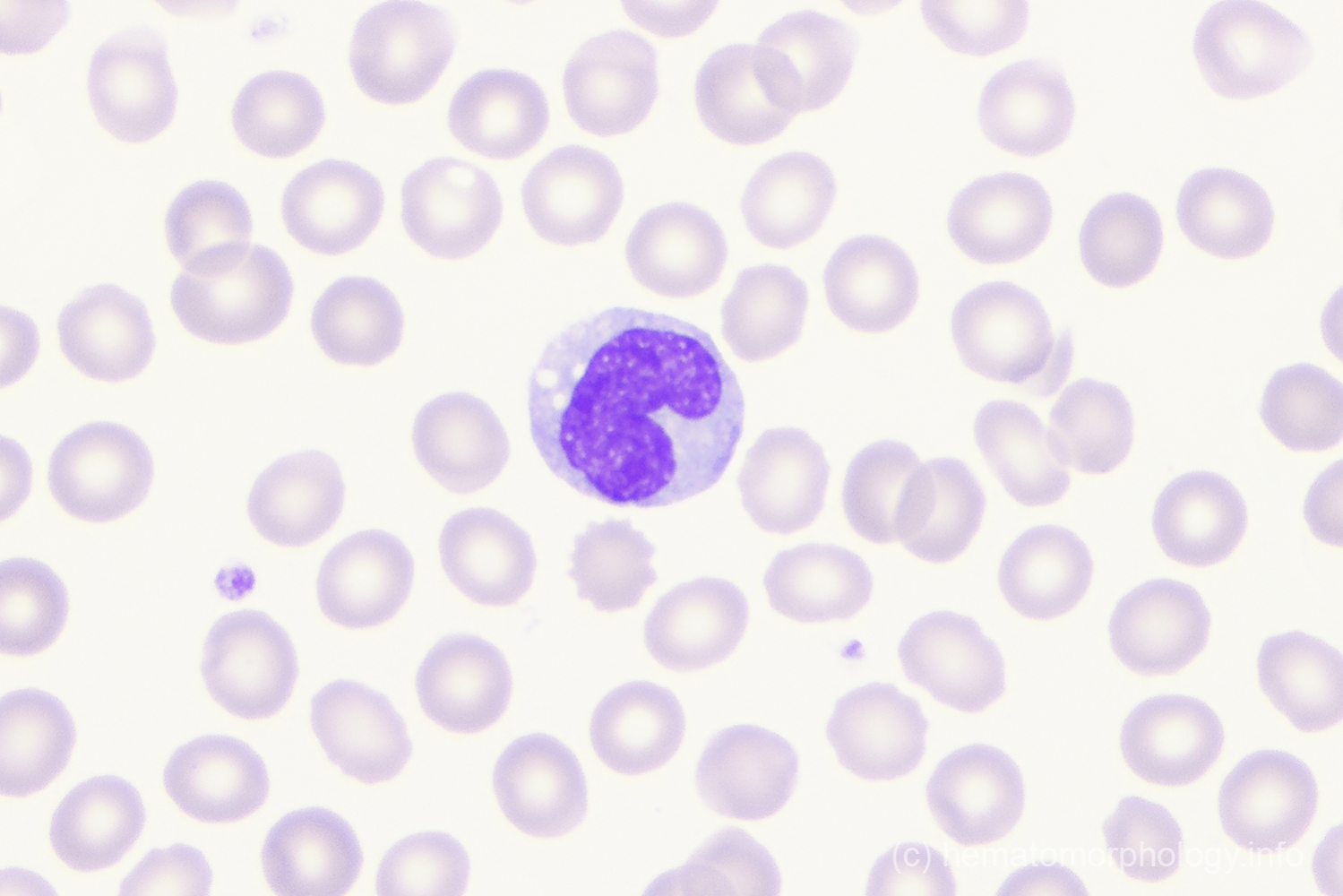 Monocytes - Hematomorphology, a databank / imagebank for hematology ...