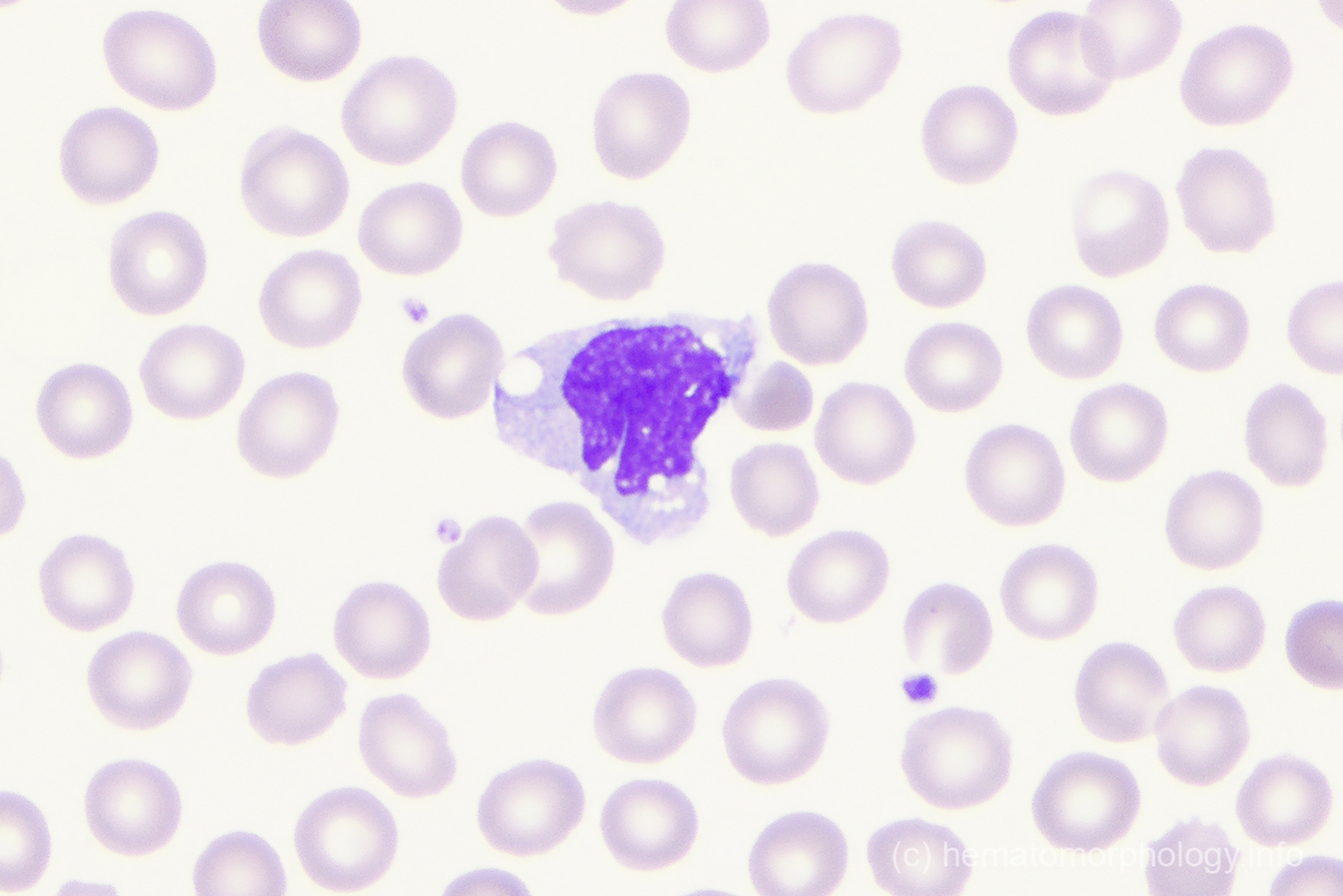 Monocytes - Hematomorphology, a databank / imagebank for hematology ...