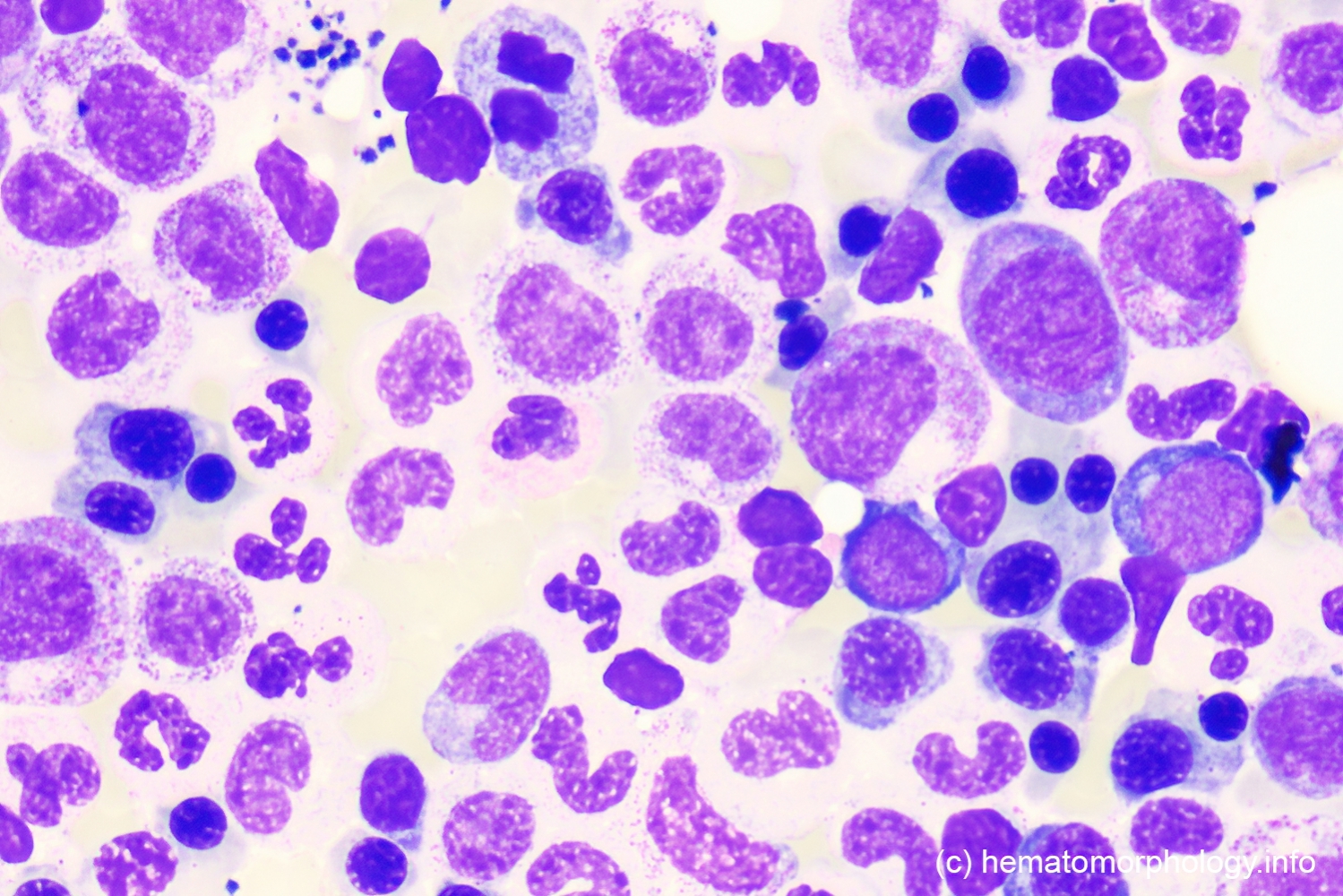 Normal bone marrow aspiration - Hematomorphology, a databank ...