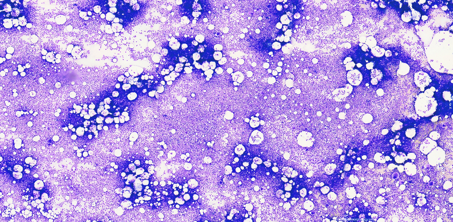 Normal bone marrow aspiration - Hematomorphology, a databank ...