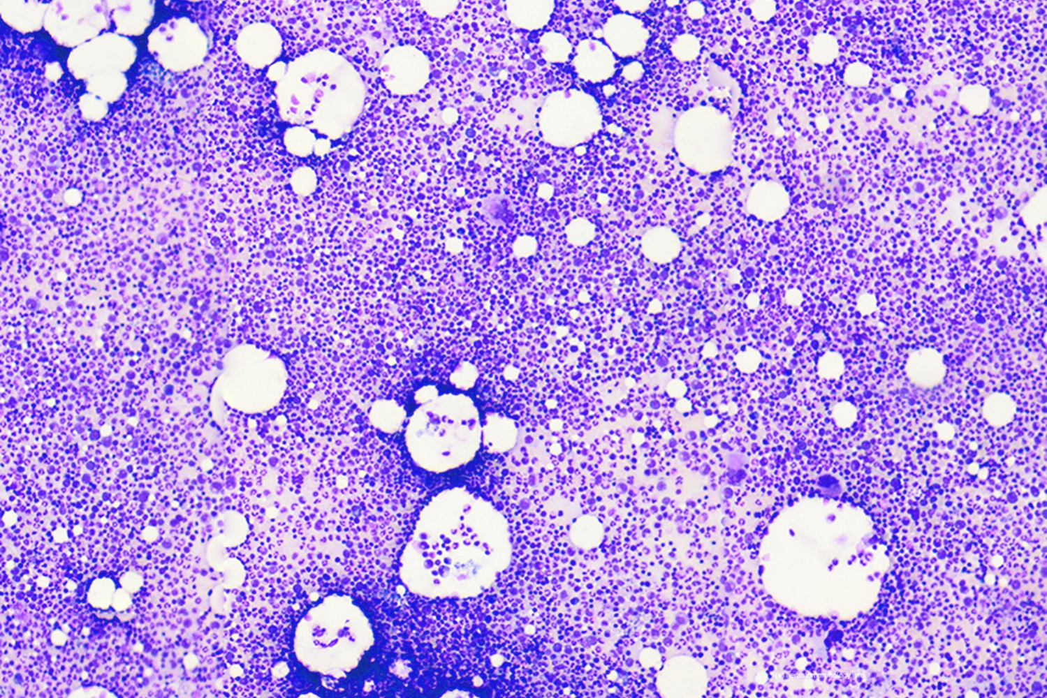 Normal bone marrow aspiration - Hematomorphology, a databank ...