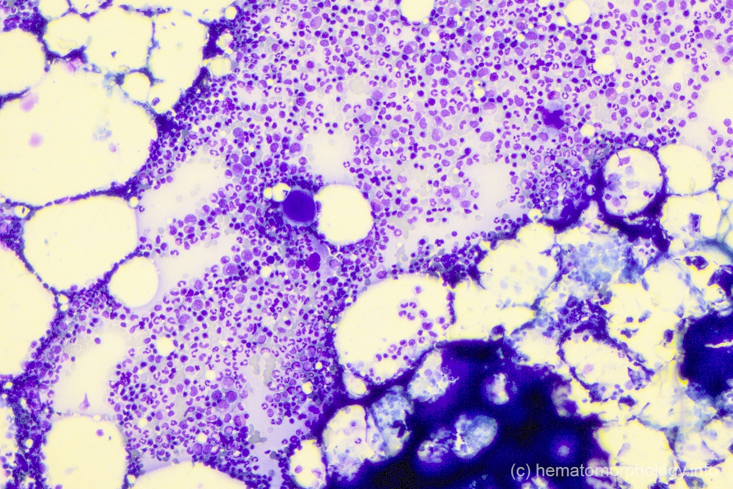 Normal bone marrow aspiration - Hematomorphology, a databank ...