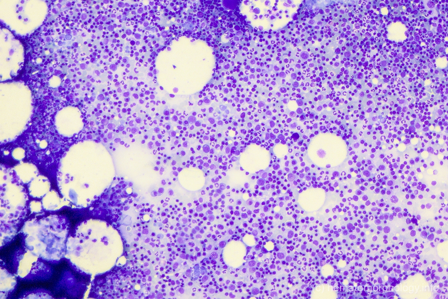 Normal bone marrow aspiration - Hematomorphology, a databank ...