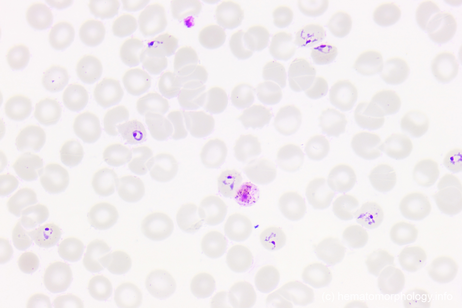 P. Knowlesi - Hematomorphology, a databank / imagebank for hematology ...