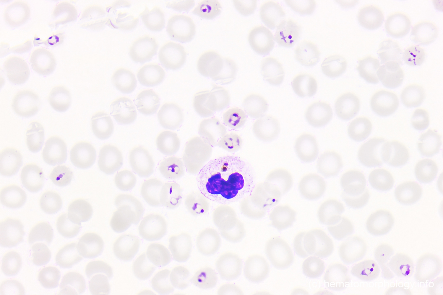 P. Knowlesi - Hematomorphology, a databank / imagebank for hematology ...