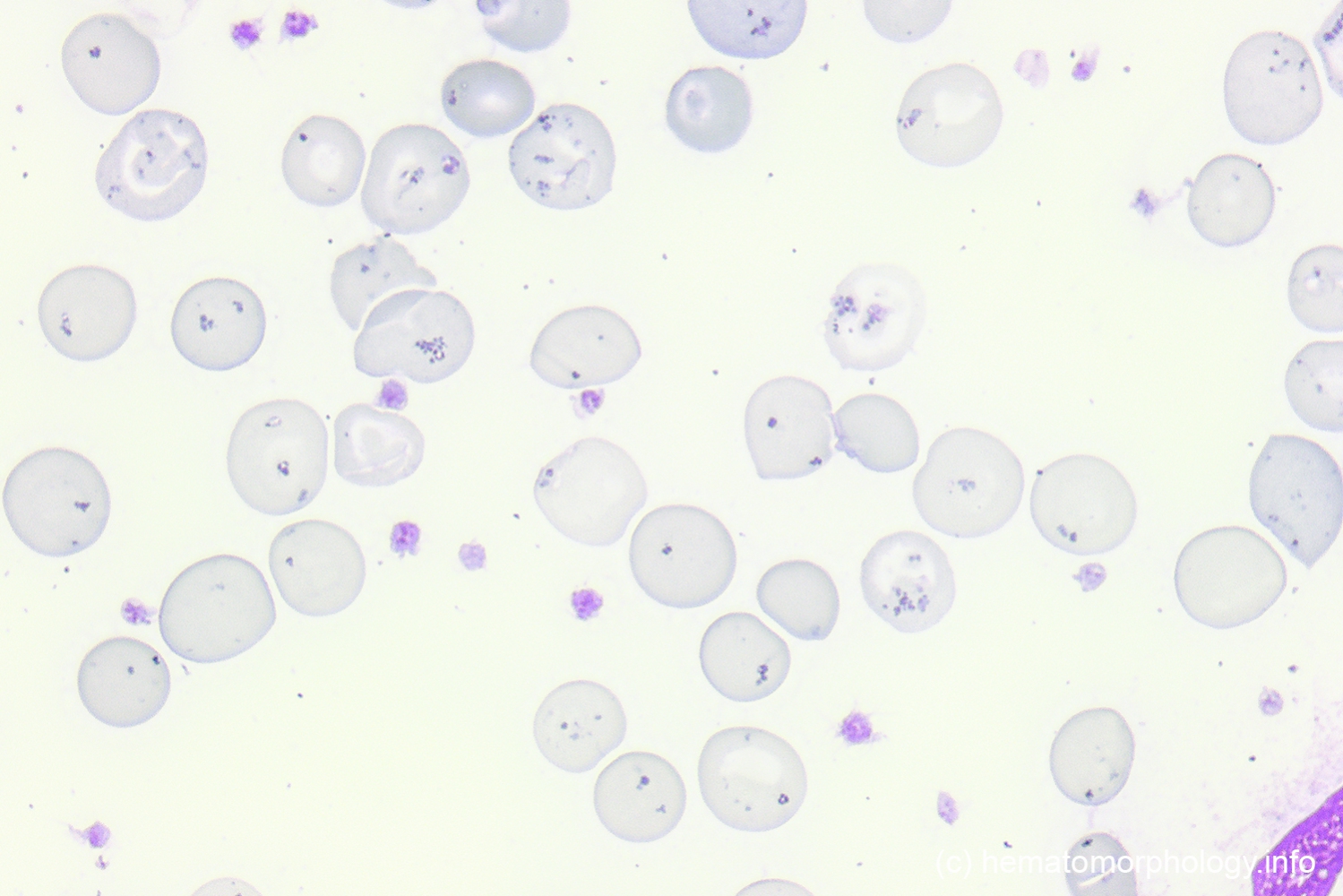 Pappenheimer bodies - Hematomorphology, a databank / imagebank for ...