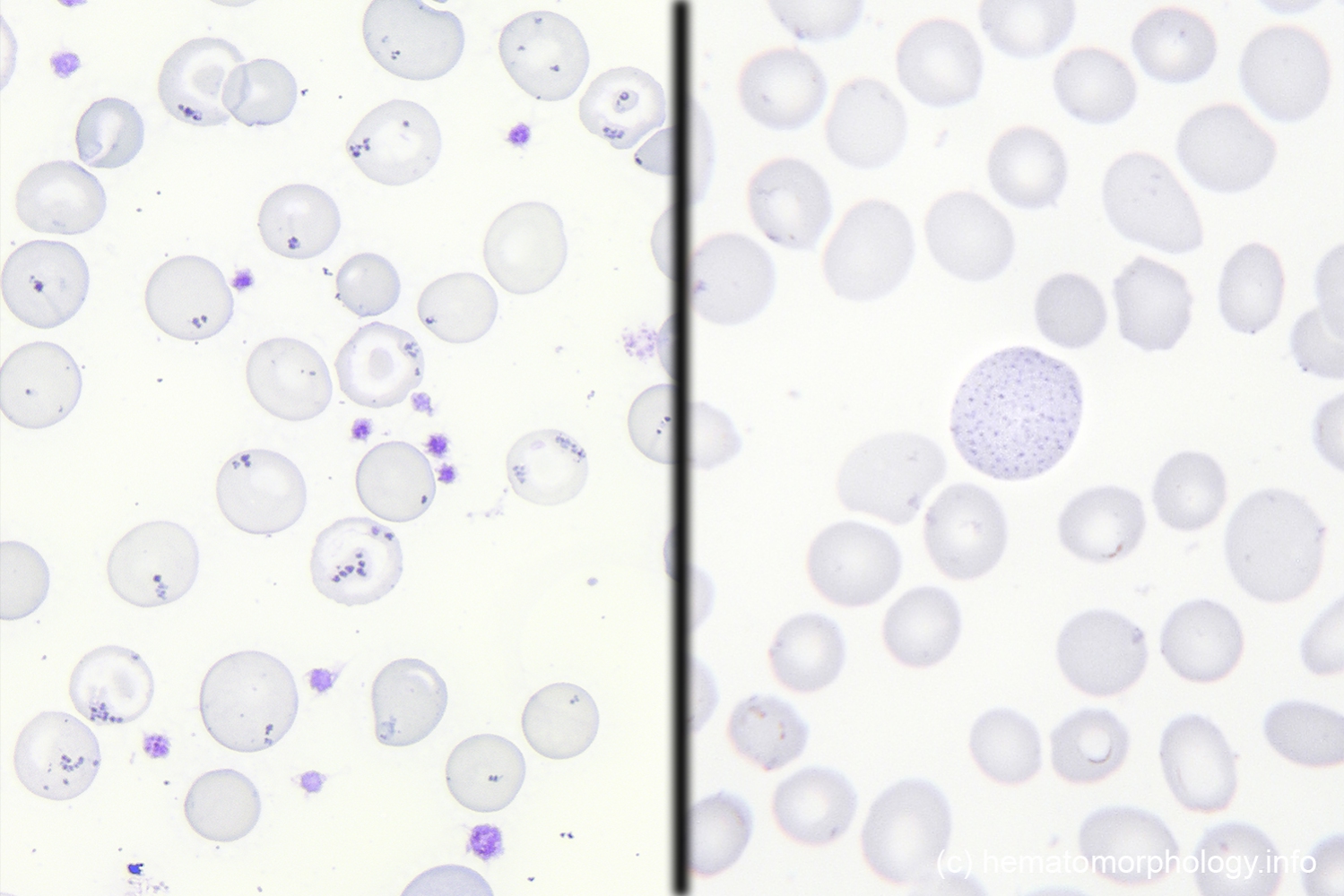 Pappenheimer bodies - Hematomorphology, a databank / imagebank for ...