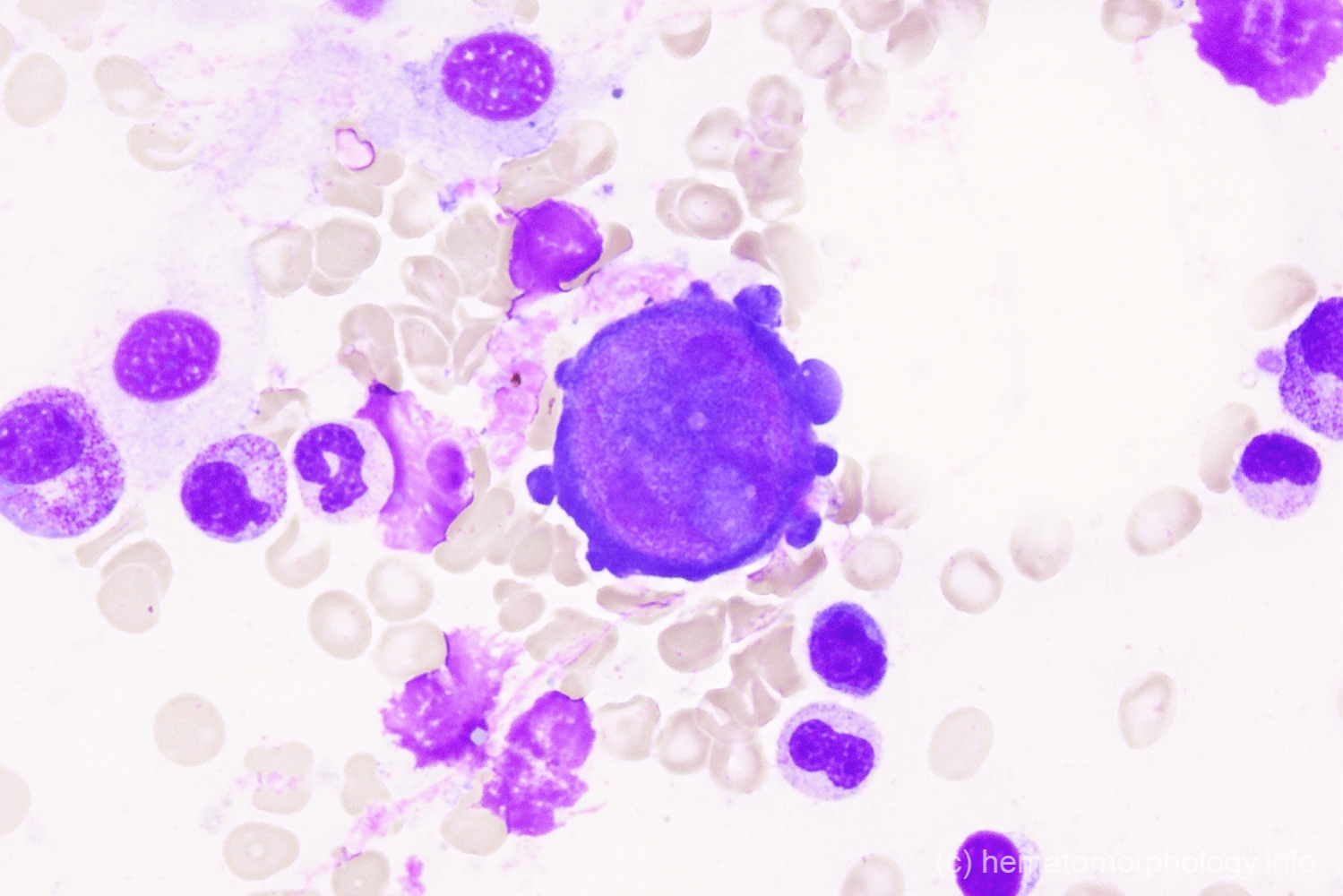 Parvo infection - Hematomorphology, a databank / imagebank for ...