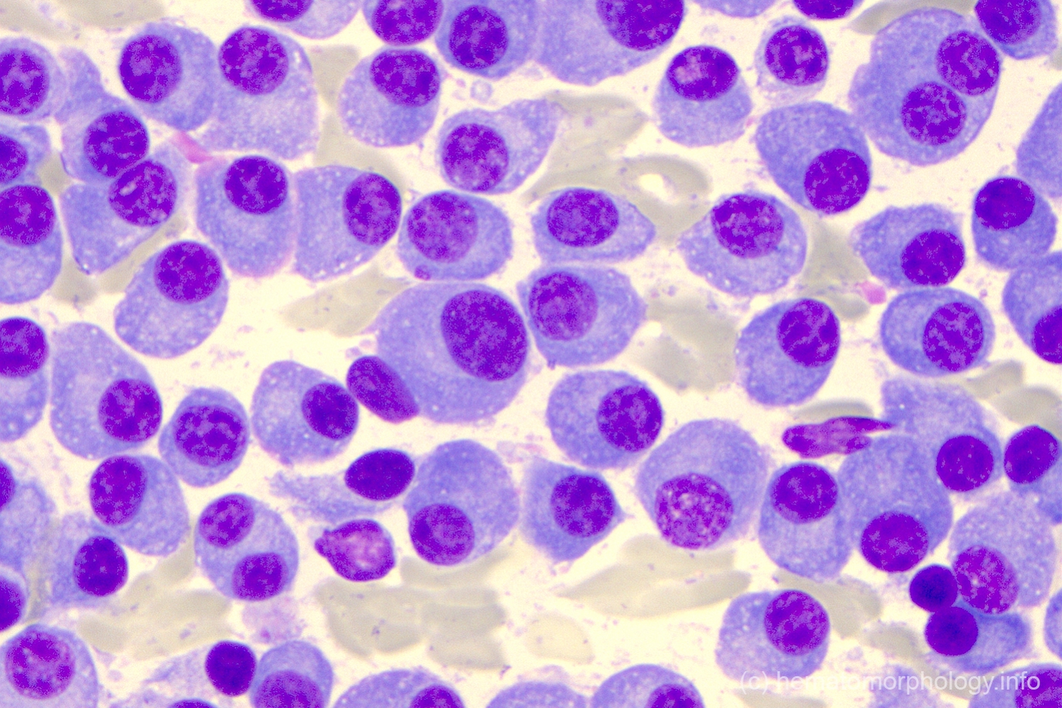 Plasma Cell Myeloma - Hematomorphology, a databank / imagebank for ...