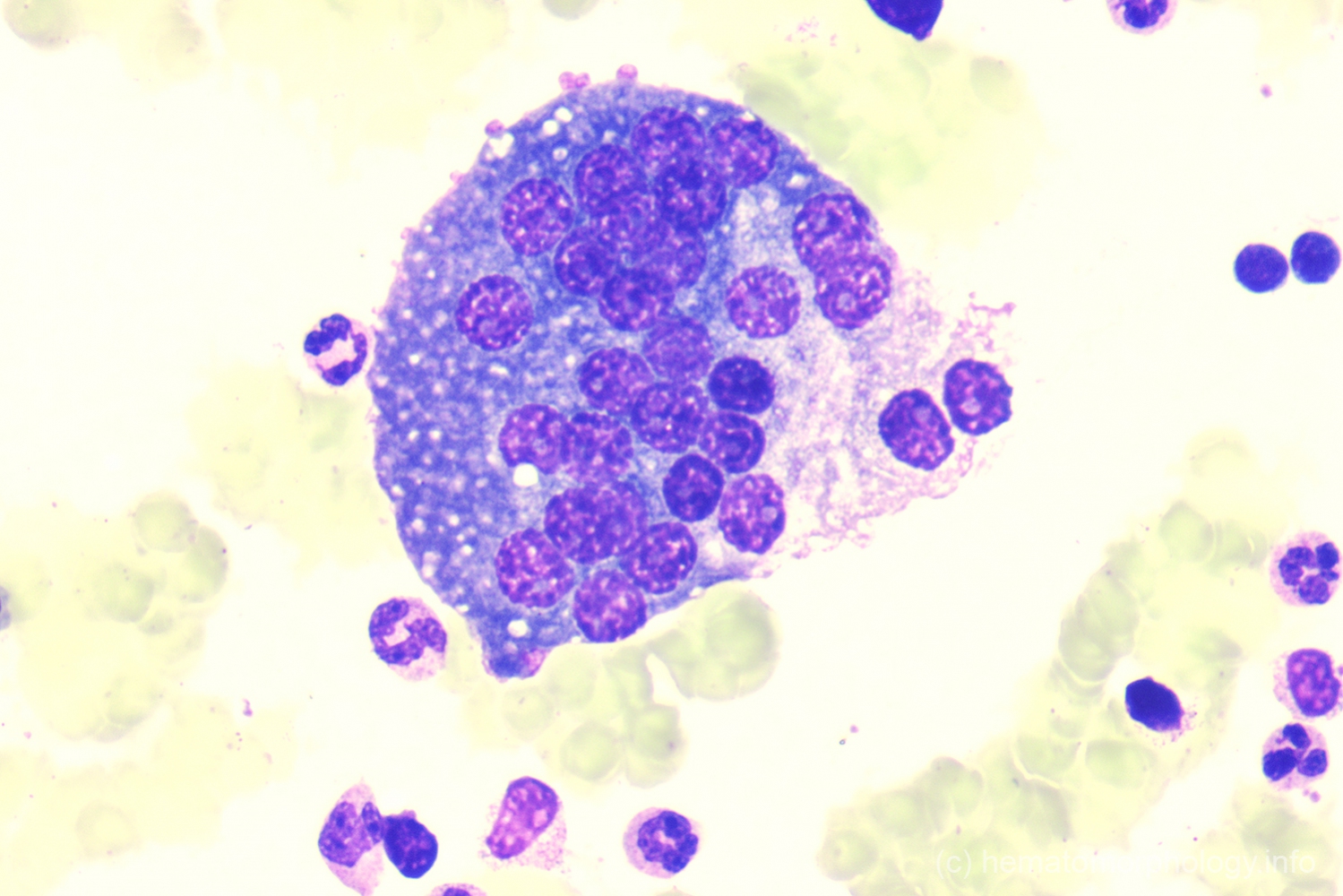 Plasma Cell Myeloma - Hematomorphology, a databank / imagebank for ...
