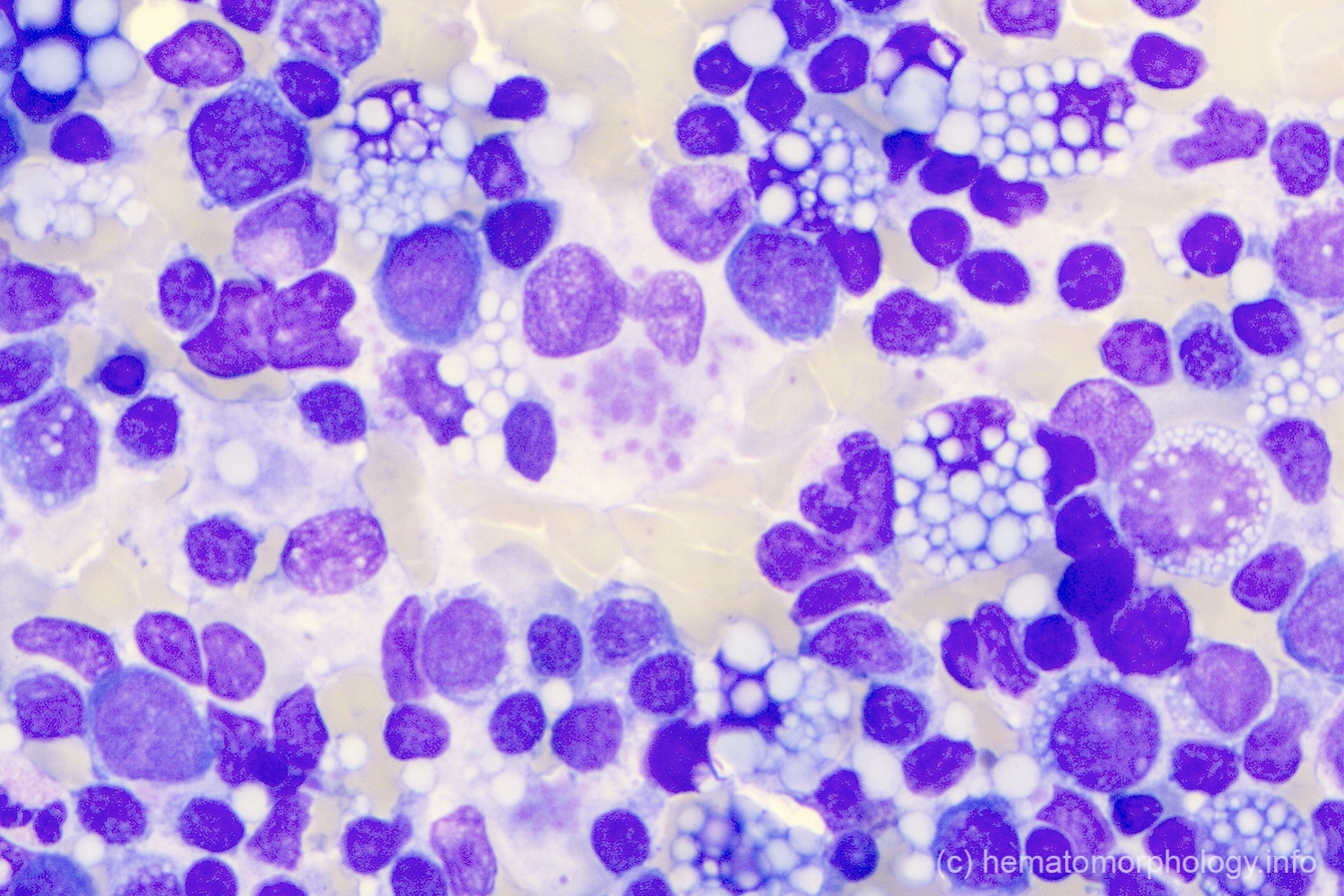 Plasma Cell Myeloma - Hematomorphology, a databank / imagebank for ...