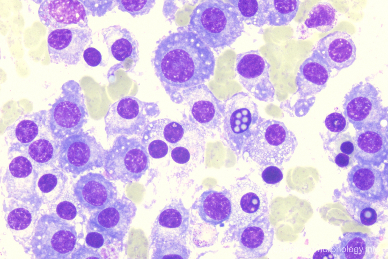 Plasma Cell Myeloma - Hematomorphology, a databank / imagebank for ...