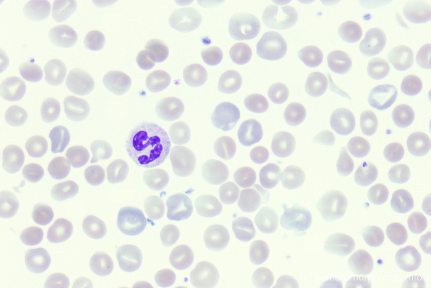 Polychromasia - Hematomorphology, a databank / imagebank for hematology ...