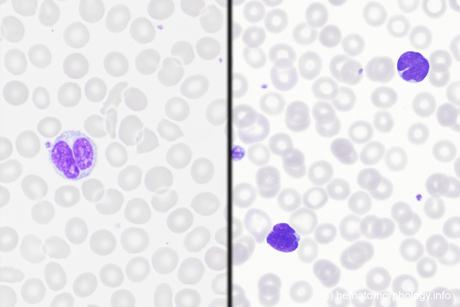 persistent polyclonal B-cell lymphocytosis (PPBL) - Hematomorphology, a ...