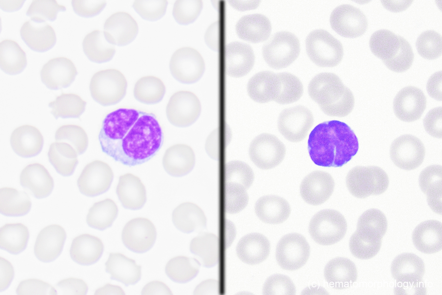 persistent polyclonal B-cell lymphocytosis (PPBL) - Hematomorphology, a ...