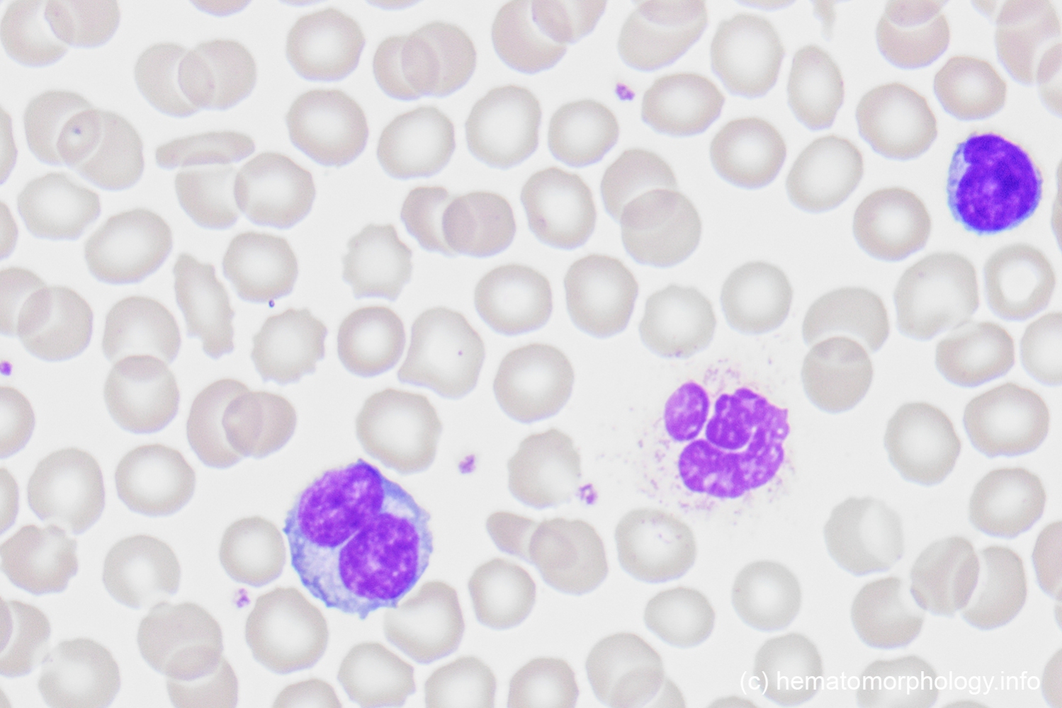 persistent polyclonal B-cell lymphocytosis (PPBL) - Hematomorphology, a ...
